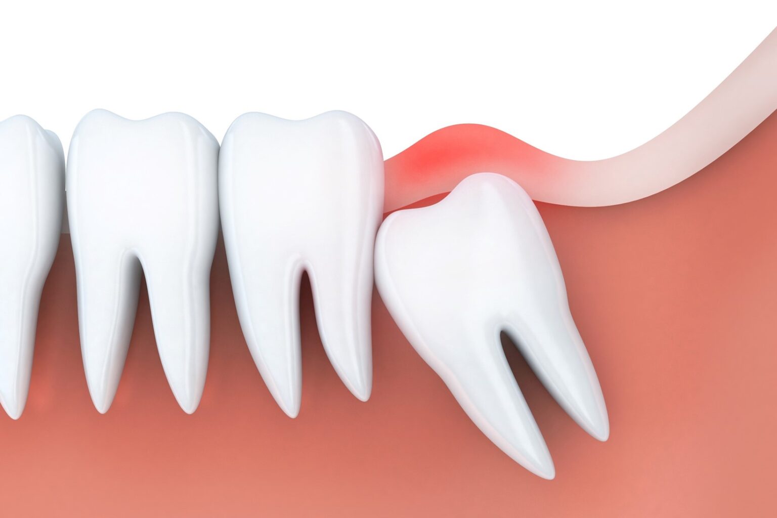Extracting Horizontal Impactions of Wisdom Teeth